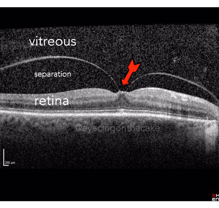 VITREOMACULAR TRACTION (VMT) | eyecing on the cake VITREOMACULAR TRACTION (VMT) | eyecing on the cake